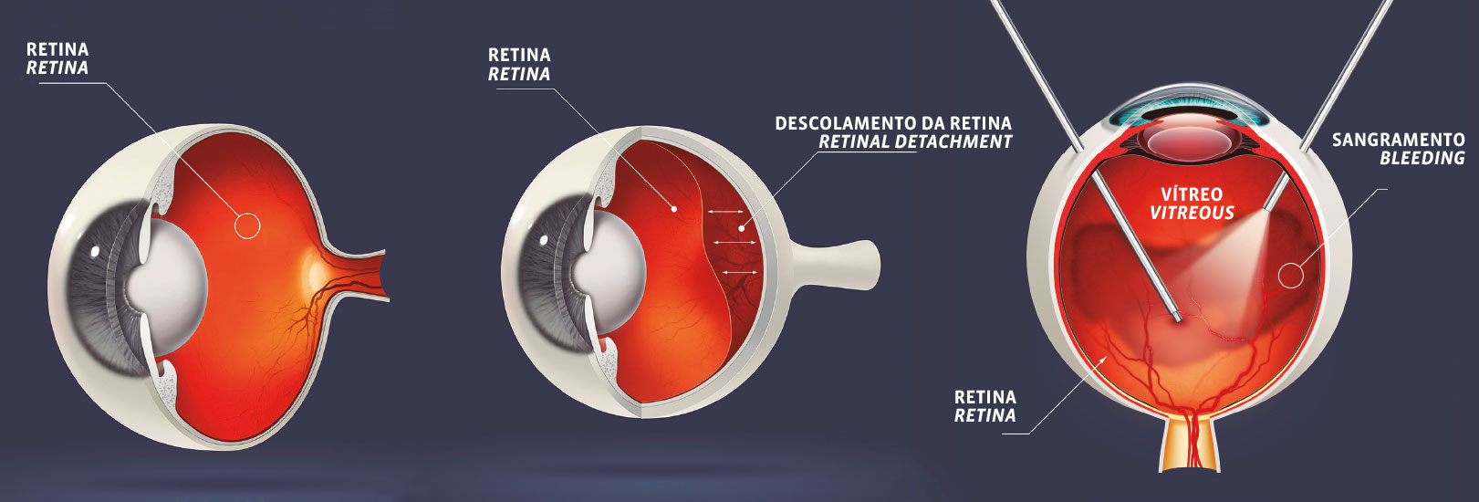 Vitrectomia. Nova cirurgia na Oftalmologia